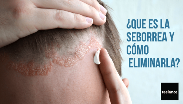 ¿Que es la seborrea y cómo eliminarla? | Reelance